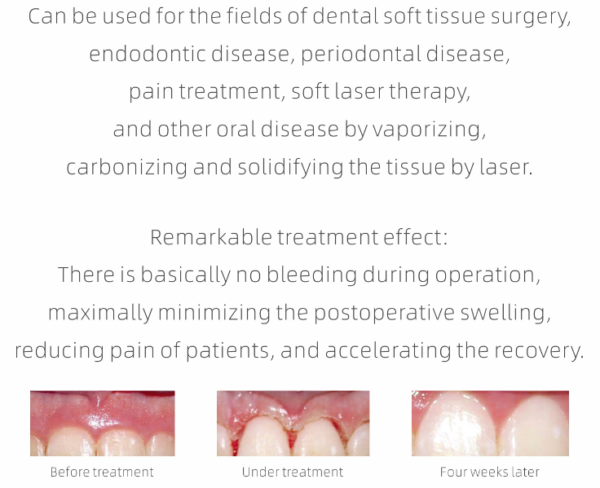 Dental Diode Laser Blue | Value-Rx, Inc.